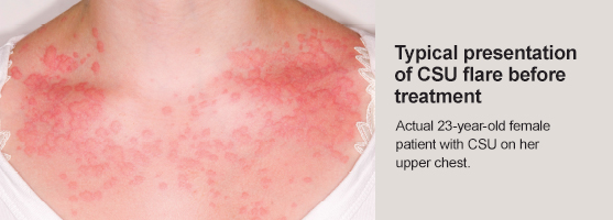 XOLAIR® (omalizumab) - FDA-Approved Treatment for CSU