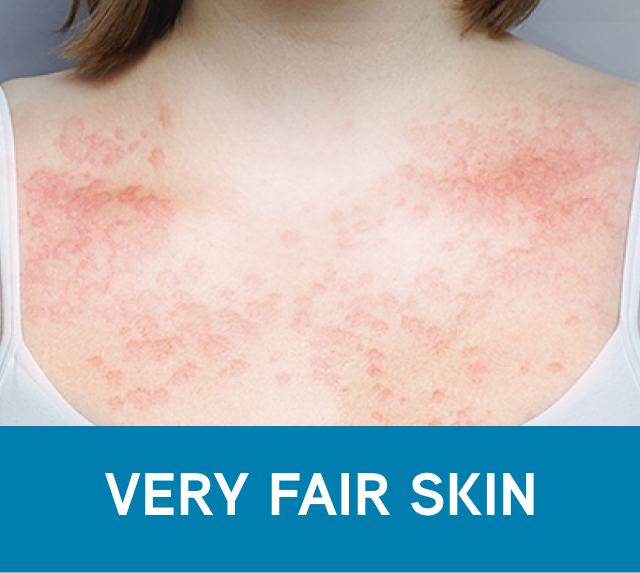 CSU Treatment Guidelines | XOLAIR® (omalizumab) | HCP