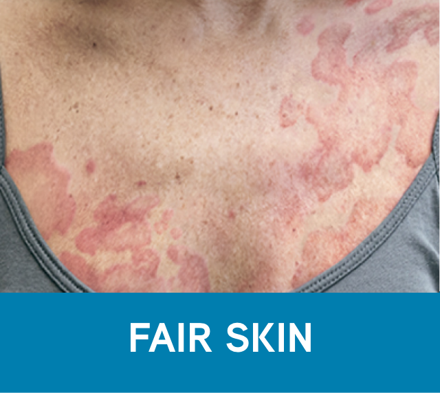 CSU Treatment Guidelines | XOLAIR® (omalizumab) | HCP