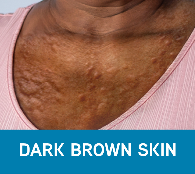 CSU Treatment Guidelines | XOLAIR® (omalizumab) | HCP