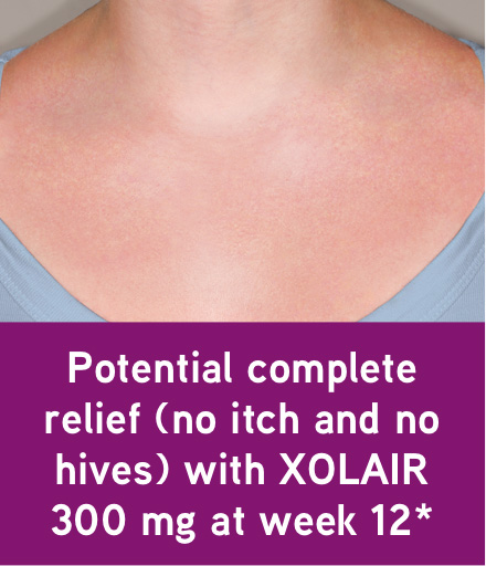 CSU Clinical Trial Results | XOLAIR® (omalizumab) | HCP