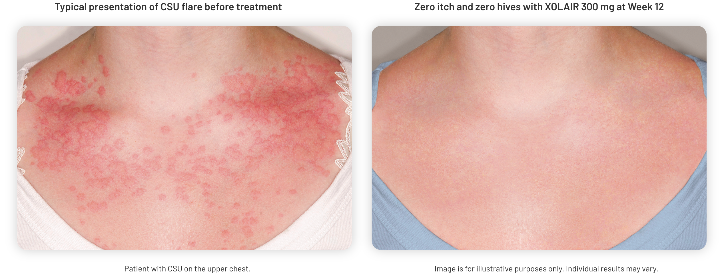 Chronic Spontaneous Urticaria (CSU) Treatment Clinical Trial Results ...