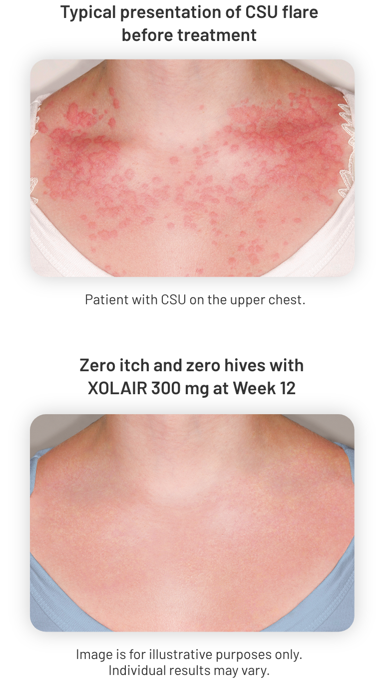 Chronic Spontaneous Urticaria (CSU) Treatment Clinical Trial Results ...