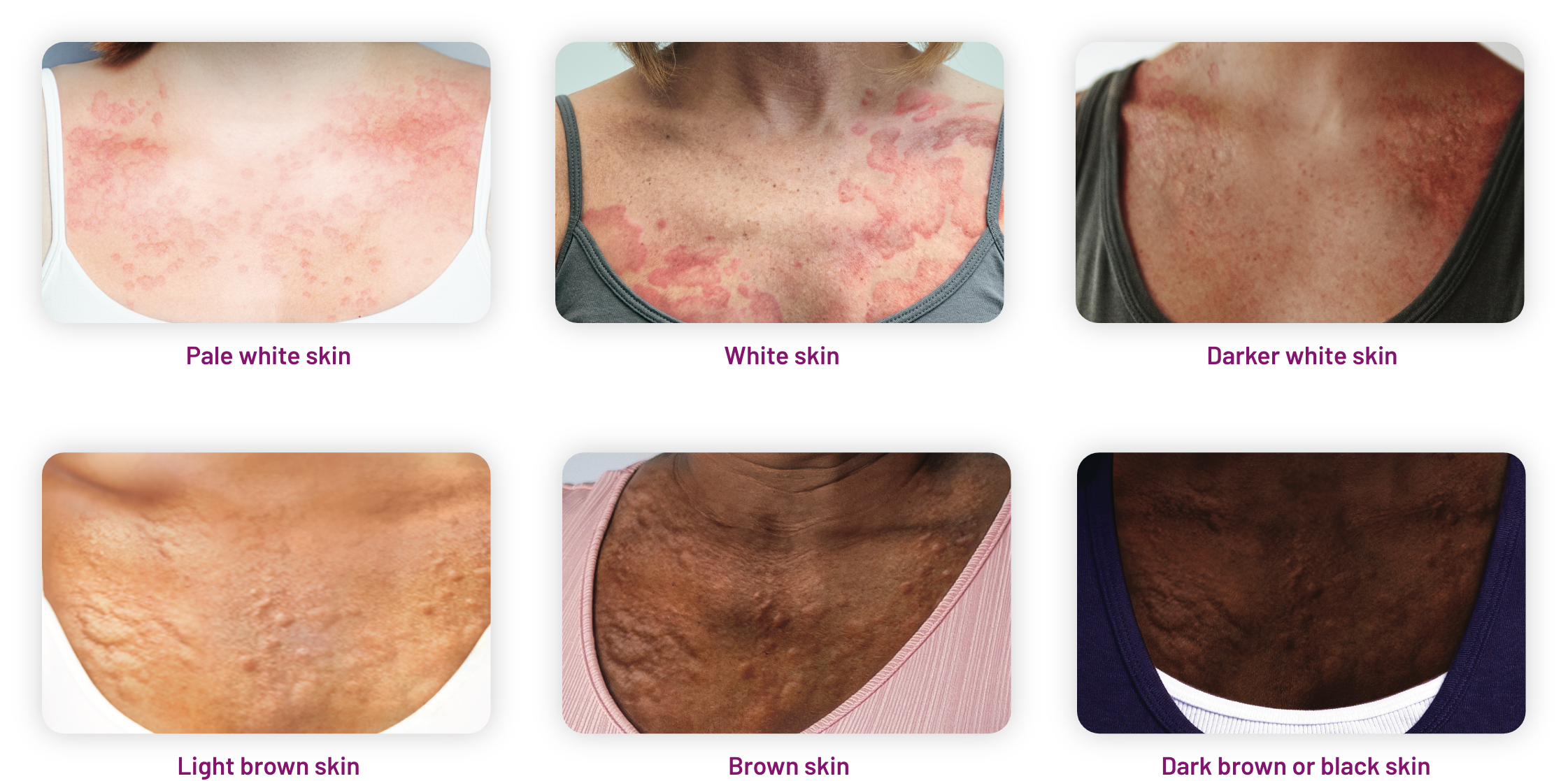 The Impact of Chronic Spontaneous Urticaria (CSU) | XOLAIR® (omalizumab ...