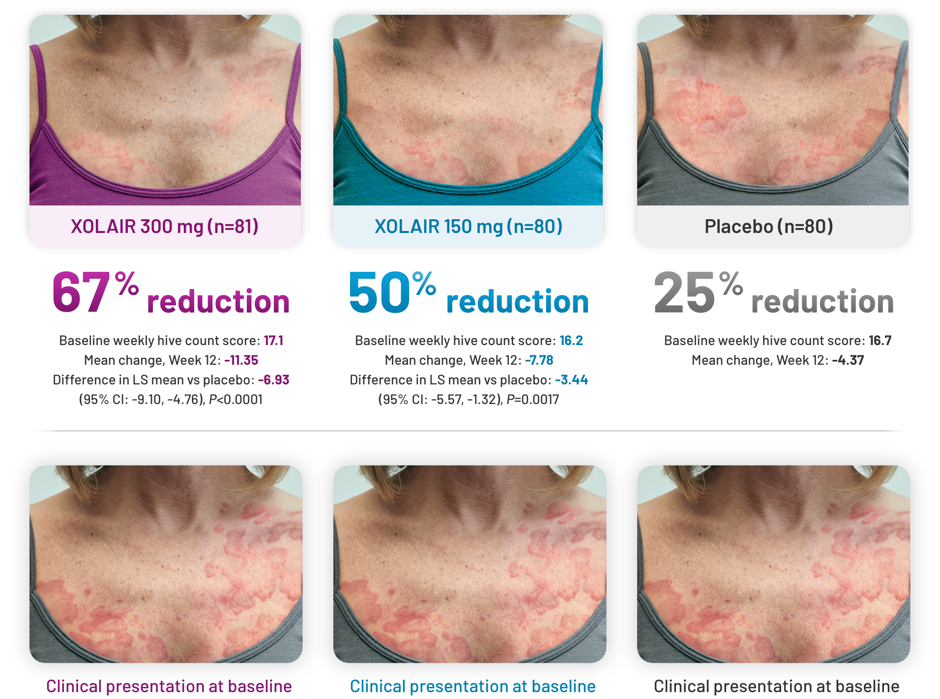 Chronic Spontaneous Urticaria (CSU) Treatment Clinical Trial Results ...