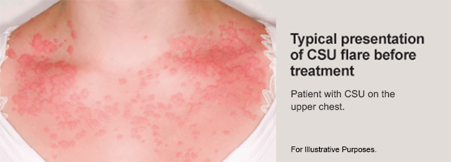 Chronic Spontaneous Urticarial | XOLAIR® (omalizumab) | HCP