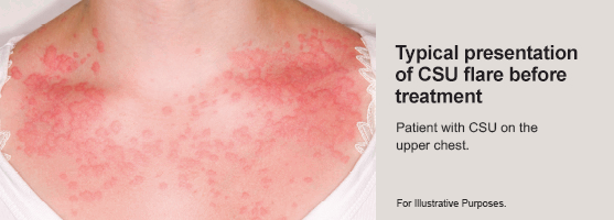 Chronic Spontaneous Urticarial | XOLAIR® (omalizumab) | HCP